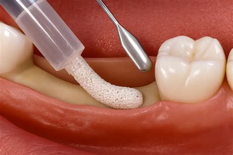 D7311 Alvéoloplastie Pour Une Récupération En Douceur Lema Dental