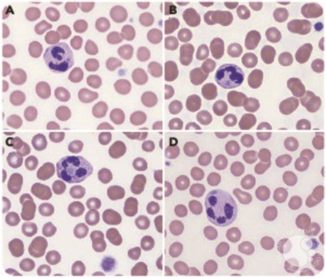 Pay Attention To Neutrophil Inclusions In Pediatric Patients With