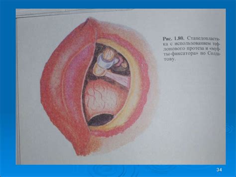 Гнойные болезни среднего уха презентация онлайн