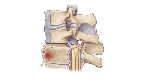 What Is Vertebral Osteomyelitis And How Do We Treat It Dallas Spine