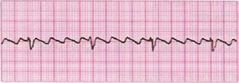 Does Atrial Flutter Always Turn Into Afib Flutter Trosbond