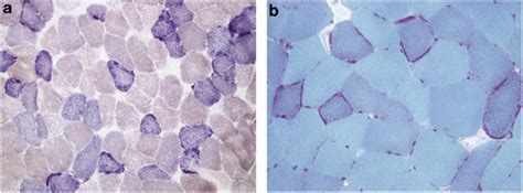 Enzymehistochemical Analyses Of Muscle A Cox Succinate Dehydrogenase