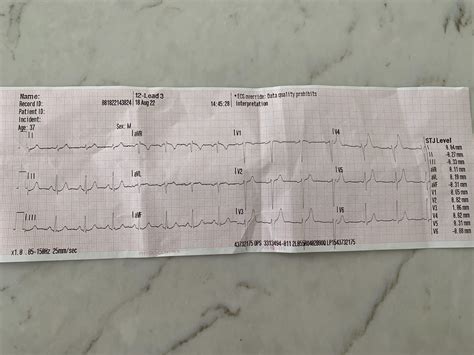 Are These Epsilon Waves In The Inferior Leads Most Visible In Avf R