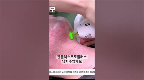 수원남자수염제모 젠틀맥스프로플러스 동영상 20250614 원스의원 수원남자제모 수원수염제모 남자제모 수염제모 젠틀맥스