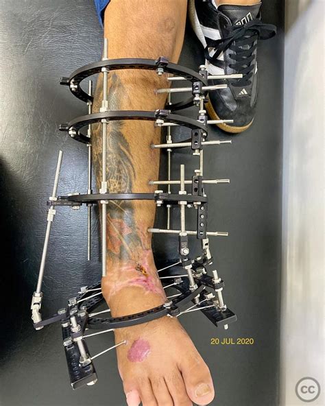 Staged Debridement Transport And Nailing Of An Open Distal Tibia With