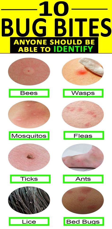 Home Remedies For Bed Bug Bites Meryindi