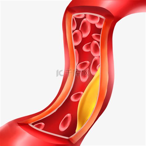 人体血管医学动脉硬化插图素材图片免费下载 千库网