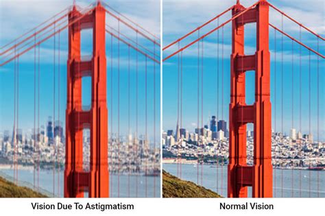 What Is Astigmatism Causes Symptoms Types And Treatment