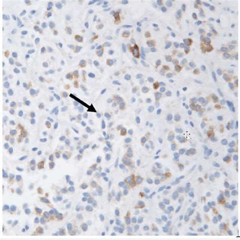 Immunohistochemical Staining For Inhibin Showing Cytoplasmic Positivity