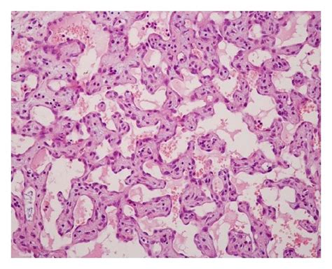 Intravascular Papillary Endothelial Hyperplasia Ipeh A Papillary