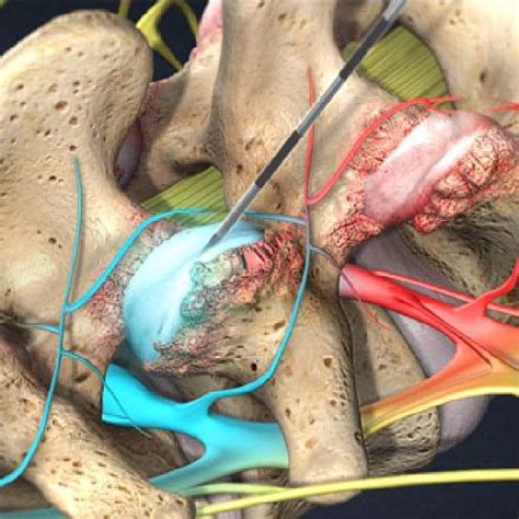 Facet Joint Injections Spine And Orthopedic Center