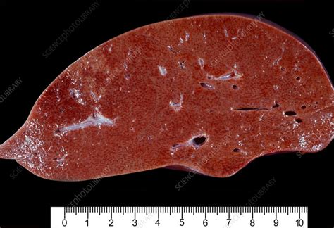 Nutmeg Liver Gross Description Case 22