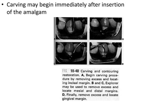 Class V And Vi Amalgam Cavity Preparations Pptx