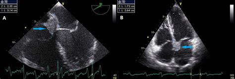 Complete Atrio Ventricular Block Due To Cardiac Metastasis Of Lung