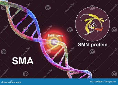 Spinal Muscular Atrophy Sma A Genetic Neuromuscular Disorder Royalty