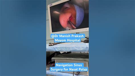 Safe Sinus Surgery By Navigation For Nasal Polyp Dr Manish Prakash
