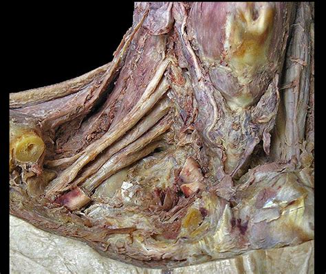 Brachial Plexus 1 Diagram Quizlet
