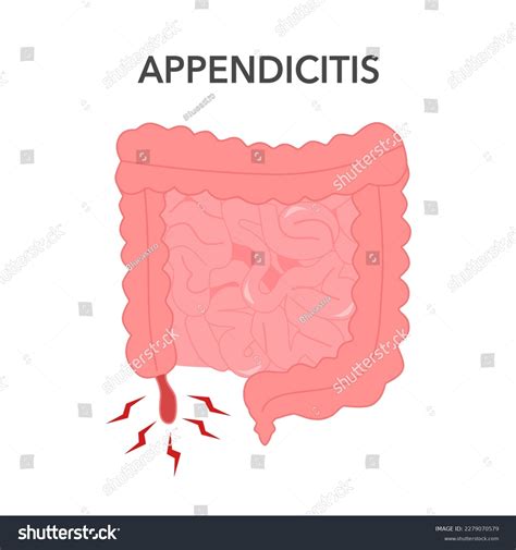 Appendicitis Concept Vector Illustration Inflammation Appendix Stock Vector Royalty Free