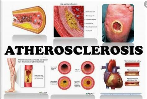 Hotissue Apakah Terjadi Aterosklerosis Karens Kolesterol