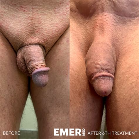 Before And After Penile Enhancement Gallery Dr Jason Emer