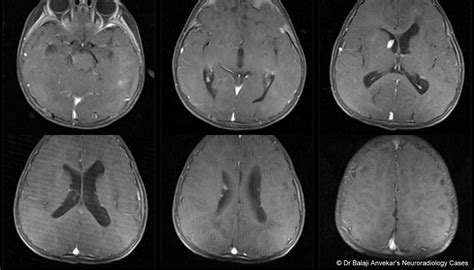 Dr Balaji Anvekar Frcr Tuberous Sclerosis