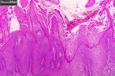Carcinoma Verrucous