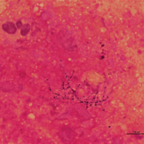 Gram Stain ×1000 Of Bronchial Lavage Fluid Showing Gram Positive Download Scientific Diagram