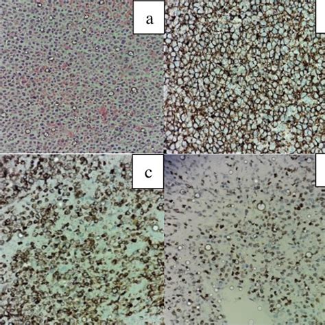 Diffuse Infiltration Of Malignant Lymphoid Cells A H And E Stain B Download Scientific