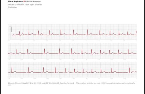 Prolonged Pr Why Are The Pauses So Long R Readmyecg