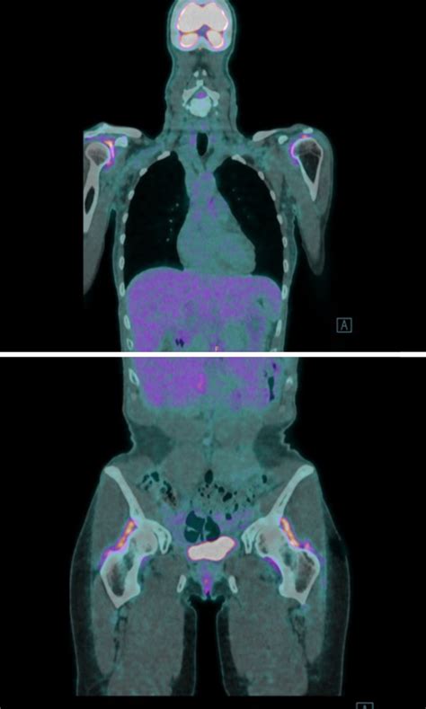 Polymyalgia Rheumatica During The Course Of Limited Cutaneous