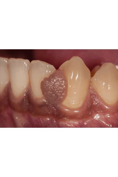 How Can Regular Screening Help The Detection Of Gingival