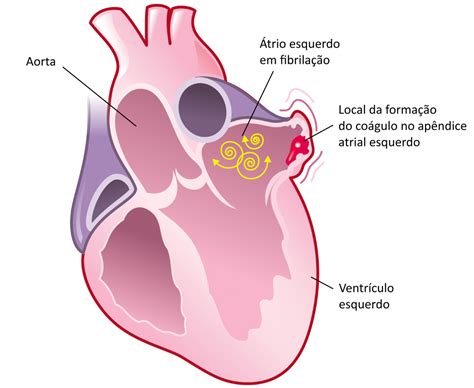 Fibrilação Atrial O Que é As Causas E Tratamento