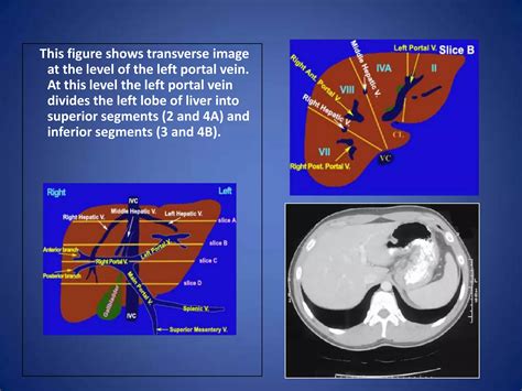 Liver Segmental Anatomy Ppt