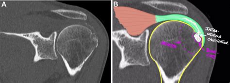Intra Osseous Migration Of Supraspinatus Calcification Benefits Of