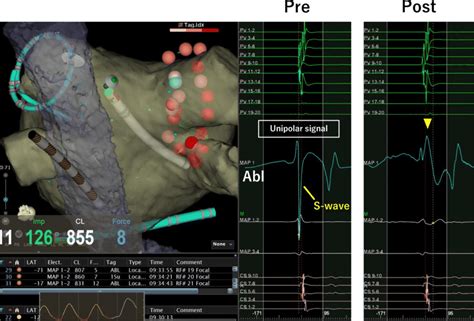Three Dimensional Electroanatomical Mapping Of Radiofrequency Ablation Download Scientific