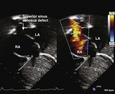 Shunting Lesions Thoracic Key