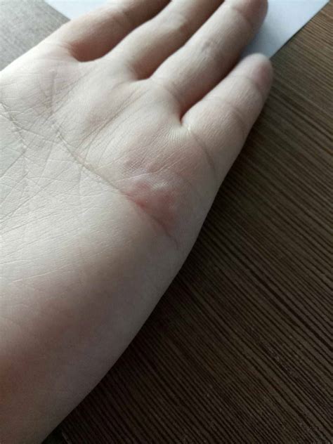 手上起小水泡~