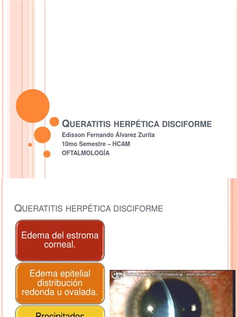 Queratitis Herpética Disciforme