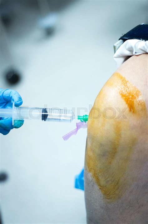 Knee Arthroscopy Orthopedic Surgery Operation Stock Image Colourbox