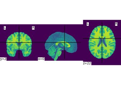 Nilearn Plotting Plot Img Nilearn