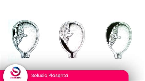 Solusio Plasenta Sehatidiri