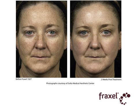 Fraxel Dual — Peninsula Dermatology