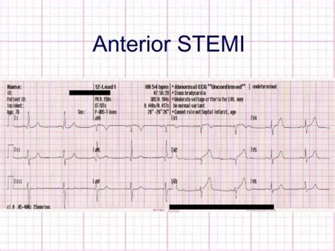 Anterior Stemi