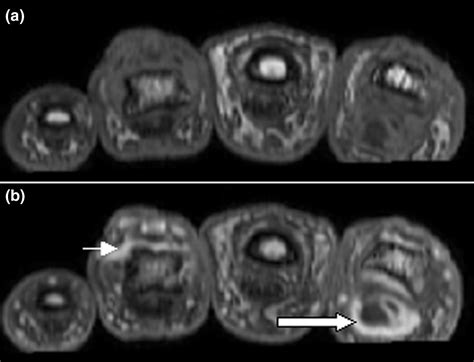 Tenosynovitis