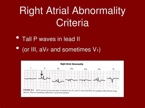 Ppt Atrial And Ventricular Enlargement Powerpoint Presentation Free