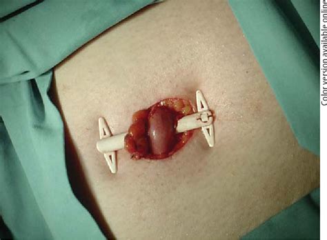 Loop Colostomy Procedure