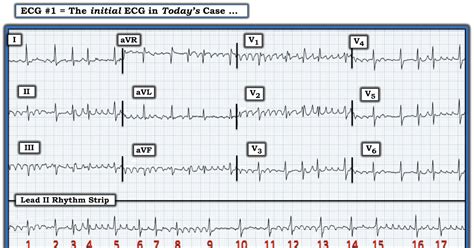 Ecg Interpretation Ecg Blog 356 — Multiple Wavelets