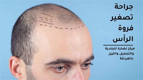 Scalp Reduction Surgery Freshness Center For Dermatology Laser And Cosmetology In Hurghada