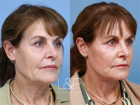 Drs Lieberman And Parikh Specialize In Customizing Each Deep Plane