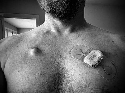 1 Year Since My Ablation Things Took An Unexpected Turn Rafib